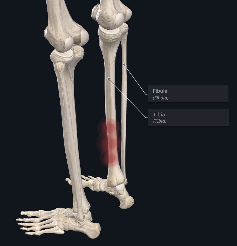 Medial tibial stress syndrom – Hvad er det og hvordan behandles det ...